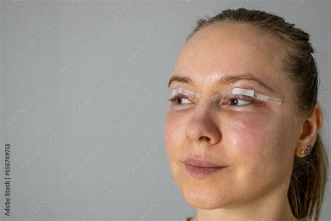 Woman Face After Plastic Surgery Blepharoplasty Operation Swelling