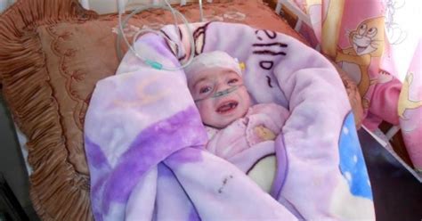 مستشفى الأطفال التخصصي بمجمع عدوان الطبي يكتشف حالة مرضية نادرة وكالة