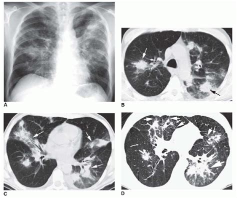 Metastatic Tumor Radiology Key