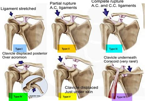 Separated Shoulder Causes Symptoms Exercises Treatment