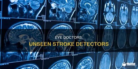 Eye Doctors Unseen Stroke Detectors Medshun