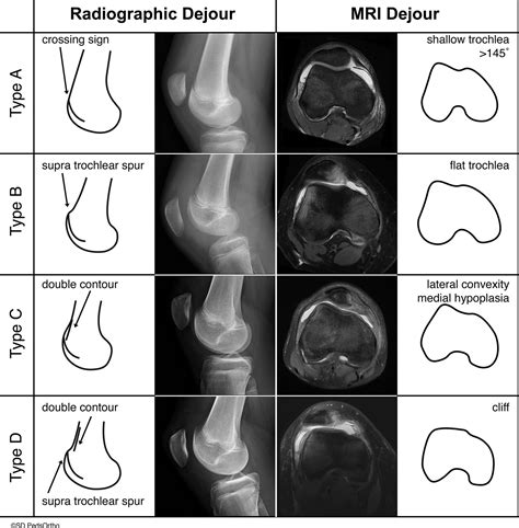 Are The Current Classifications And Radiographic Measurements For