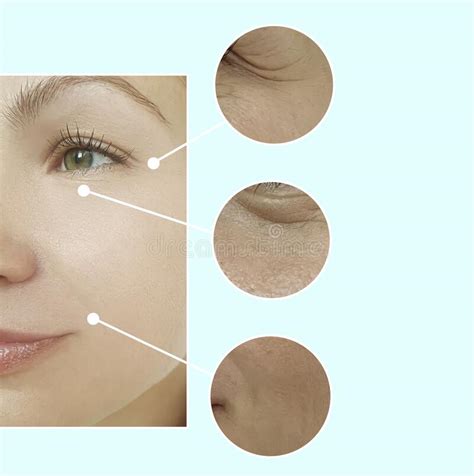 Woman Face Wrinkles Removal Before After Regeneration Difference Effect