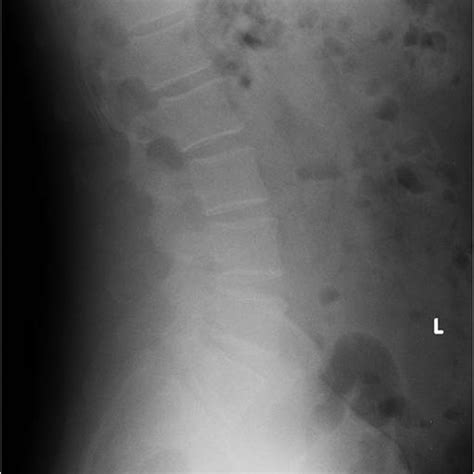 Lateral Lumbar X Ray Shows Mild Multilevel Degenerative Disc Disease