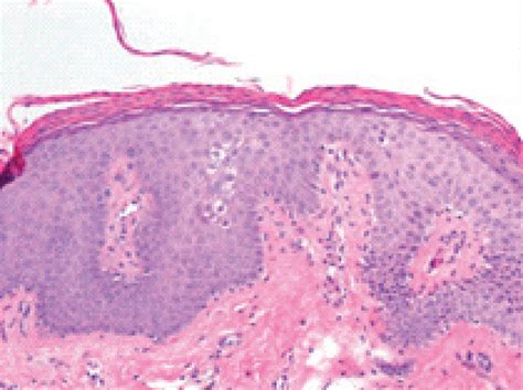 Inflammatory Fibrous Hyperplasia