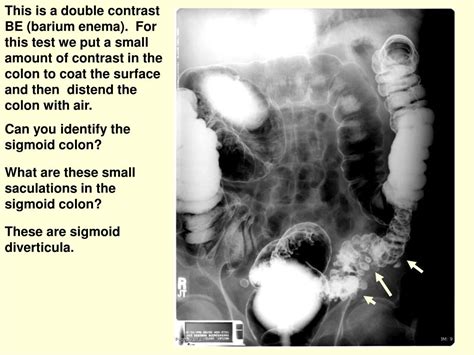 Ppt Can You Identify The Sigmoid Colon Powerpoint Presentation Free
