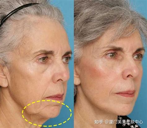 厦门热玛吉 热玛吉多少钱如何辨别热玛吉真假 知乎