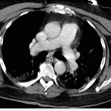 Ct Angiogram Chest Negative For Pulmonary Embolism Ct Computed