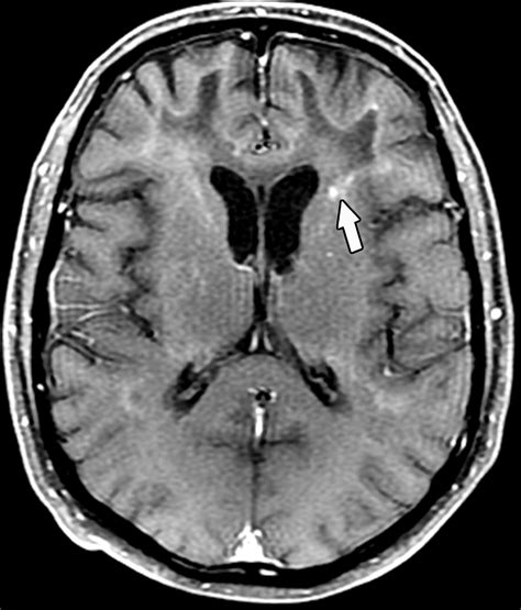 Adult Leukodystrophies A Step By Step Diagnostic Approach Radiographics