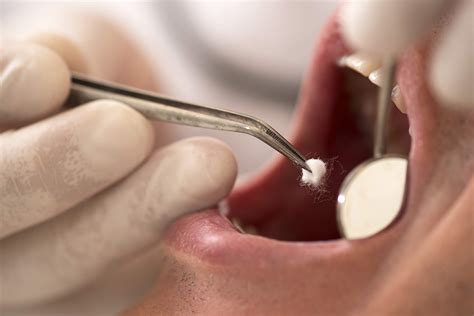 A Difficult Crown Impression Dr Beatrice Leung