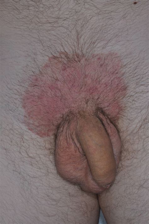 Tinea Genitalis A New Entity Of Sexually Transmitted Infection Case