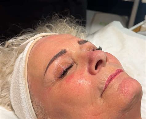 The Benefits Of Microneedling And Why We Use Led Light Therapy For Best