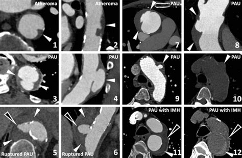 Aortic Dissection And Other Acute Aortic Syndromes Diagnostic Imaging