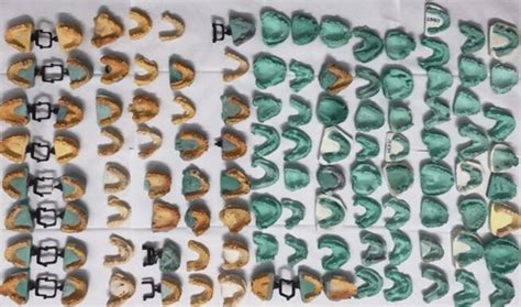 The Prevalence Of Alveolar Ridge Defects According To Seiberts