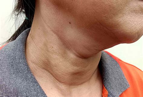 Hypothyroidism Symptoms Testing Treatment Diet