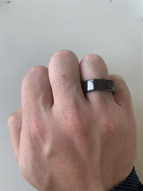Dry Ed Skin After Wearing Oura Ring On A Daily Basis Anyone Else Have This Issue R Ouraring