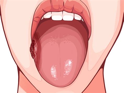 Pictures Of Early Signs Of Tongue Cancer