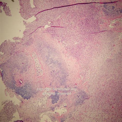A Tumor In The Fibula Discovered By Accident