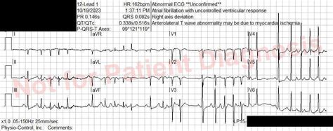 Afib W Wpw To Sinus W Weird Ectopy R Ekgs
