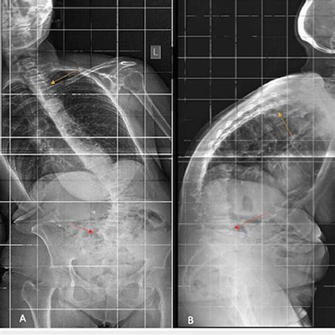 The Preoperative Anteroposterior A And Lateral B Radiographs Of A