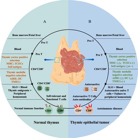 Thymoma Vs Thymic Hyperplasia At Amy Christensen Blog