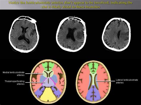 Ppt Neuroradiology Ct Rotation For 1 St Year Radiology Residents