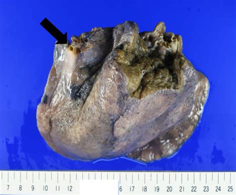 Intralobar Pulmonary Sequestration Presenting As Multiple Nodular