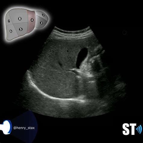 Couinauds Liver Segments Sonographic Tendencies Segmentation