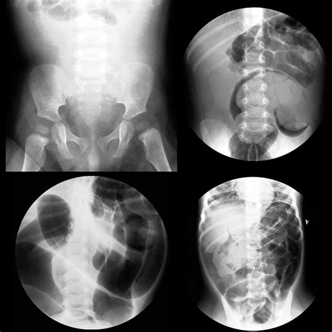 Ileocolic Intussusception Pediatric Radiology Reference Article
