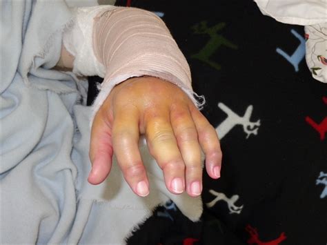 Heres Your Gold Watch Rheutired Wrist Fusion Surgery