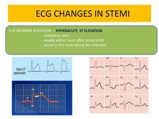 Ecg In Stemippt