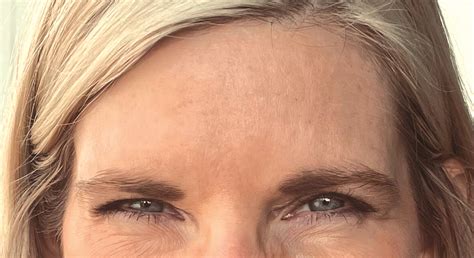 Botox Vanity Or Medical Treatment