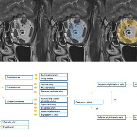 Us Of An Infantile Hemangioma Ih Of The Left Orbit In A 5 Month Old