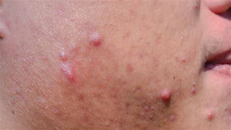 Whiteheads On Chin That Wont Go Away