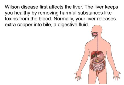 Patedu Wilson Disease