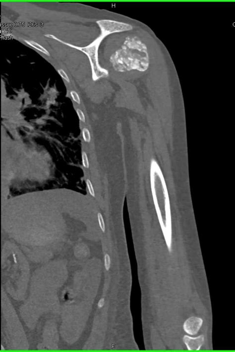 Chondrocalcinosis Vs Normal