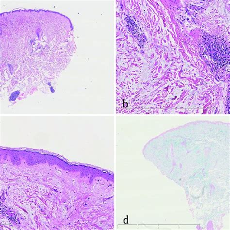 Well Defined Rubbery Skin Coloured To Light Erythematous Plaques
