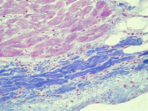 Subendocardial Fibrosis Col Tricromic Mallory Ob 40x Download Scientific Diagram