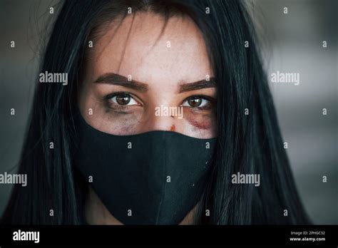 Portrait Of Beaten Young Woman In Black Protective Mask With Bruise