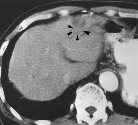 Ct Features Of Intraductal Intrahepatic Cholangiocarcinoma Ajr