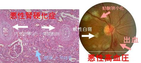 内分泌高血圧 閉経後更年期高血圧 悪性高血圧 高レニン高アルドステロン高血圧薬剤誘発性高血圧