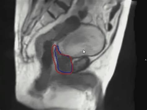 An Example Of Real Time Imaging During A Prostate Mrgrt Treatment The Download Scientific