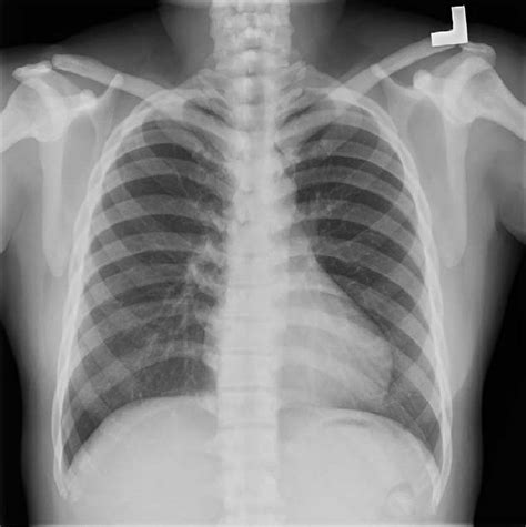 Chest X Ray On May 26 2005 Revealed Hyperostosis Of The Clavicles