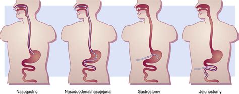 Different Types Of Enteral Feeding Tubes At Jeremy Nilsson Blog