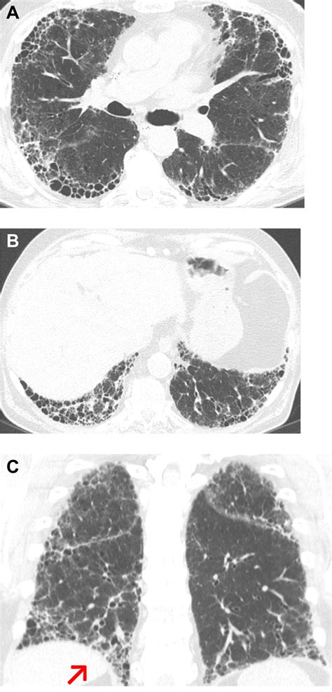 7 Diffuse Parenchymal Lung Disease Thoracic Key Parenchymal Lung