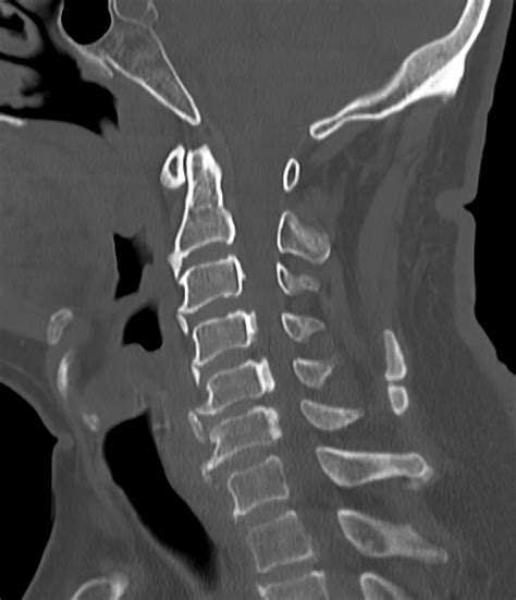 Ligamentum Nuchae Cadaver