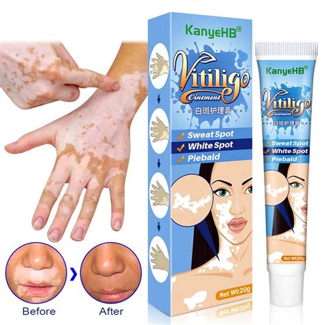 허브 추출물 백반증 연고 백선 제거 피부 백반증 치료 크림 20g Aliexpress