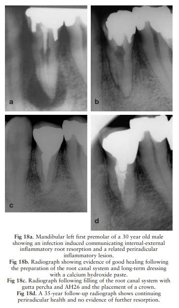 Endodontic Communicating Internal External Inflammatory Resorption