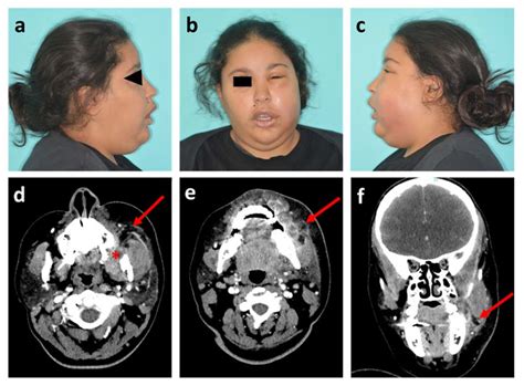 Cellulitis Mouth