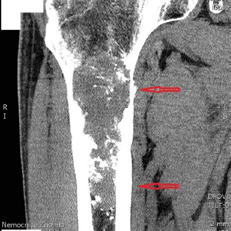 Diffuse Osteolytic Process Of The Spine Download Scientific Diagram